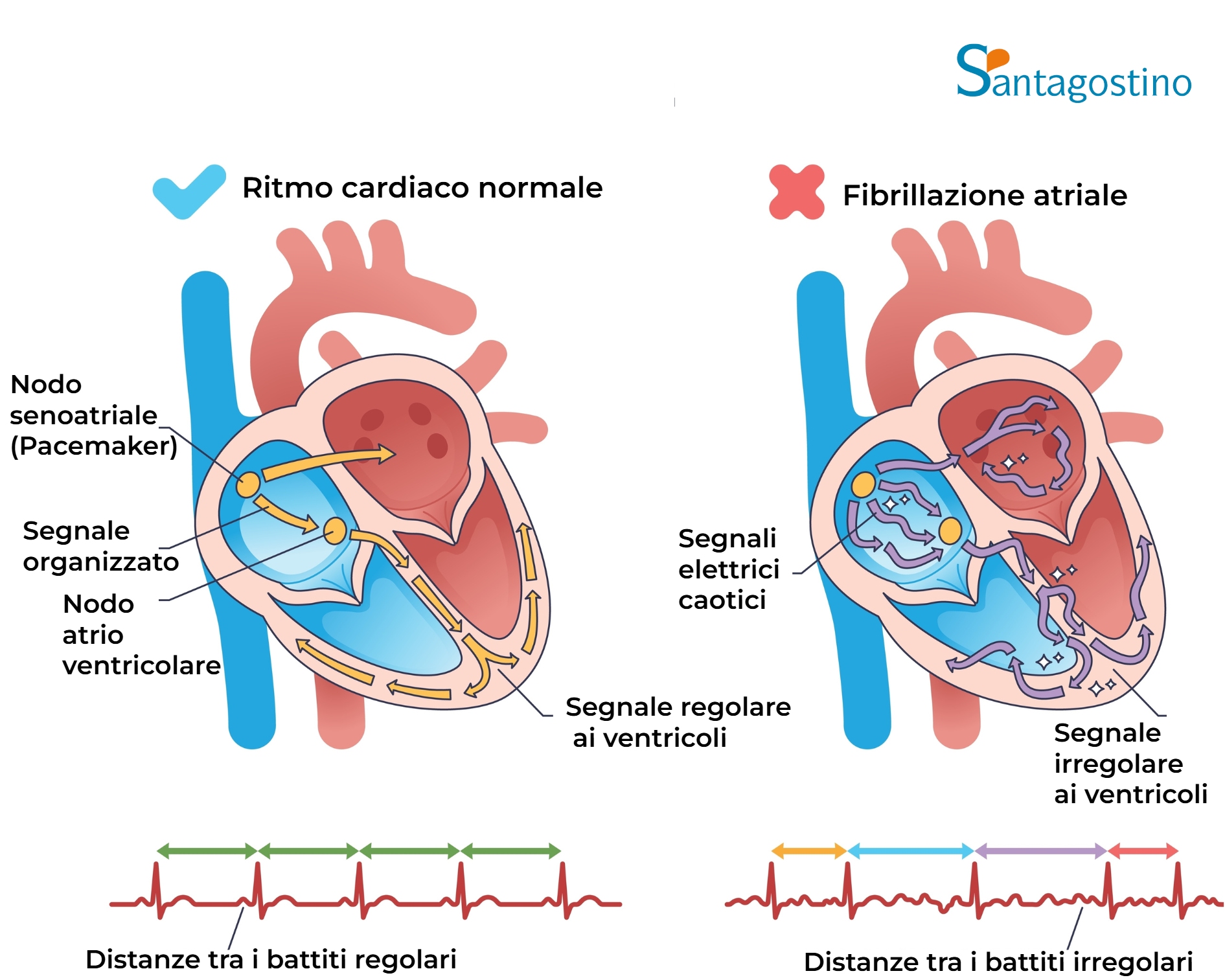 Fibrillazione atriale: sintomi, rischi e trattamenti - Santagostino ...